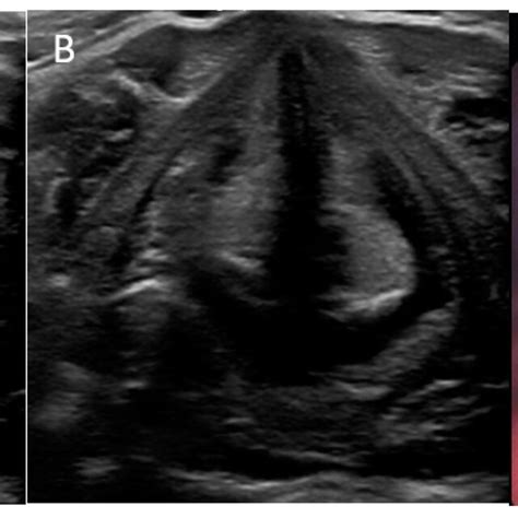 An Example Of Left Sided Paralysis Visible Asymmetry Of Vfs And