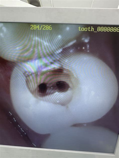 Dr Shebin Varghese On Linkedin Rootcanaltreatment Dentist Toothanatomy Medical