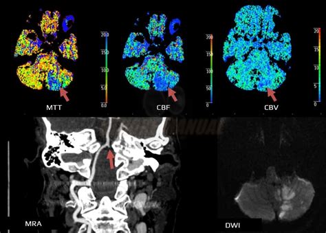 ct perfusion ctp stroke manual