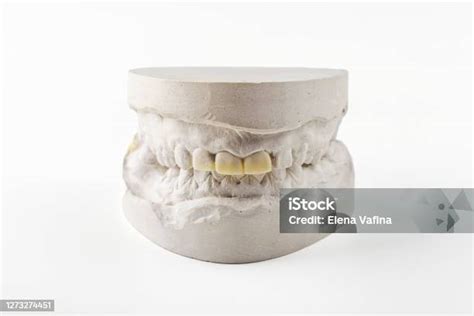 스토마토로직 석고 캐스트 흰색 배경에 인간의 턱과 치아의 금형 의치 중괄호 또는 거짓 치아의 제조를위한 치과 주조 석고 치과 및 치열 교정 개념 0명에 대한 스톡 사진 및