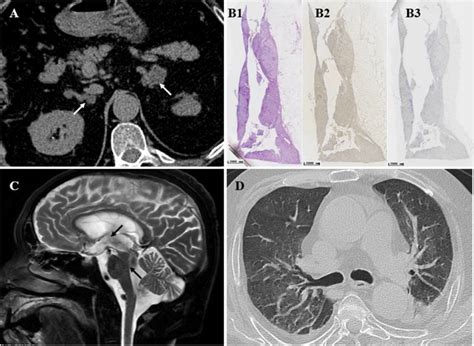 Imaging Features Of The Patients Adrenal Lesions And Cryptococcal