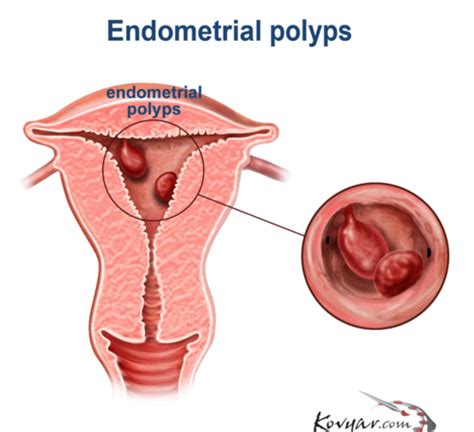 Uterine Polyps Removal