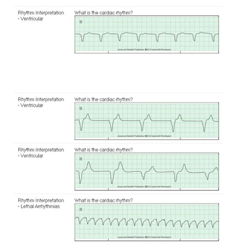 Solved Rhythm Interpretation Ventricular Rhythm