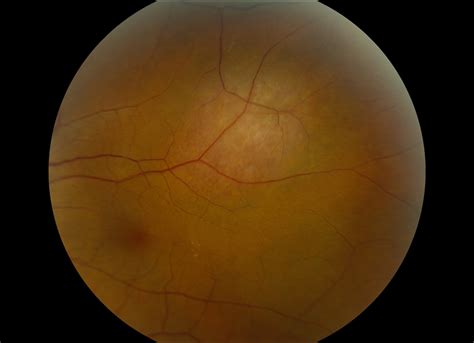 Atlas Entry Circumscribed Choroidal Hemangioma