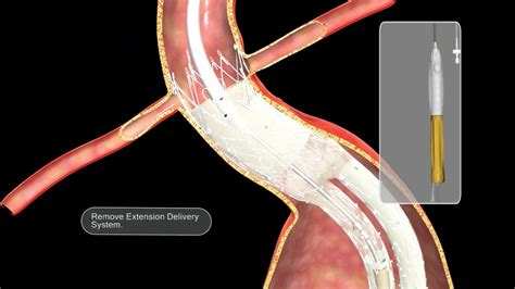 Incraft™ Aaa Stent Graft System Aortic Extension Deployment Guide Youtube