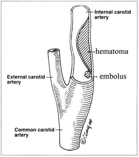 Sudden Neck Movement And Cervical Artery Dissection Cmaj