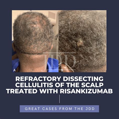 Dissecting Cellulitis DC Archives Next Steps In Dermatology