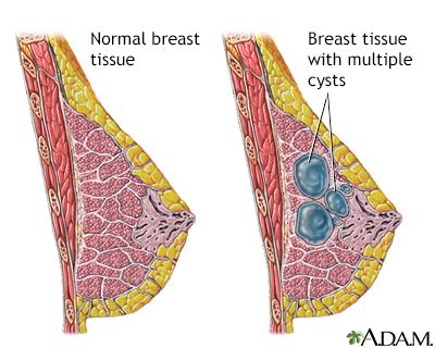 Fibrocystic Breast Hrt