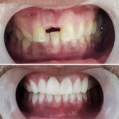 Dental Bridges In Colombia Dental Tourism Colombia