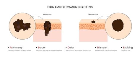 Premium Vector Melanoma Warning Signs