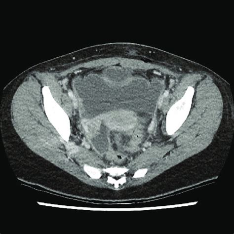 Initial Enhanced Abdominal Ct Scan Showing Free Pelvic Fluid Download Scientific Diagram