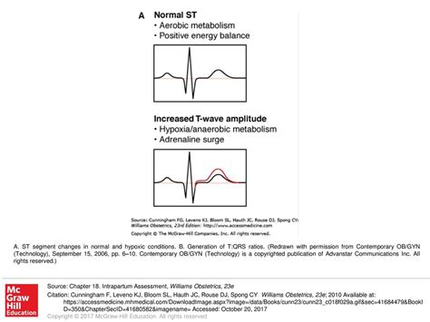A ST Segment Changes In Normal And Hypoxic Conditions B Ppt Download