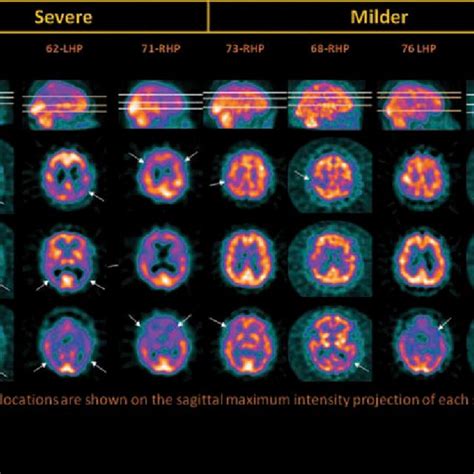 Sample Spect Slices Of Each Patient From Their Last Spect Scan To