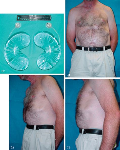 Component Separation For Complex Abdominal Wall Reconstruction And