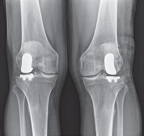 Partial Knee Replacement And Sports At Jessica Zelman Blog