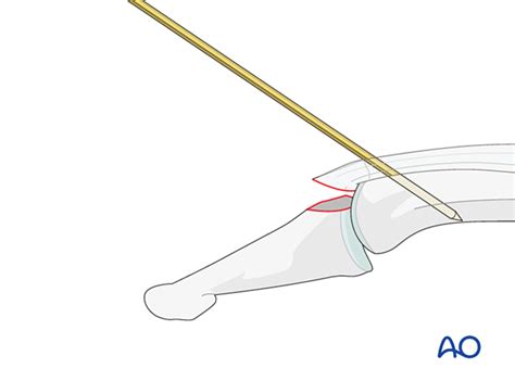 Extensor Block Pinning Or K Wire Fixation With Joint Transfixation
