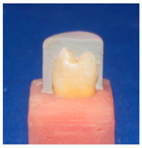 Laminate Technique Dentistry At Sharlene Burcham Blog