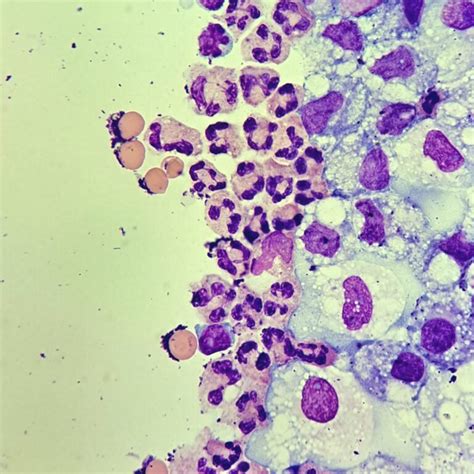 Body Fluid Monocytes Macrophages Medlabbuddy