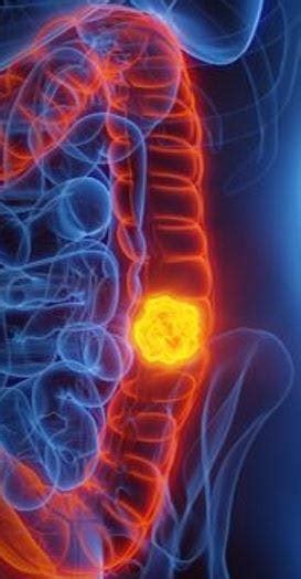 Next Generation Cologuard Surpasses Fit For Colorectal Cancer Detection