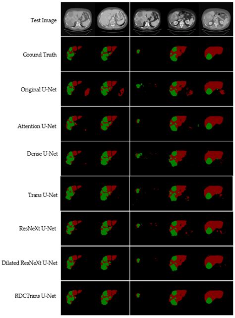 Rdctrans U Net A Hybrid Variable Architecture For Liver Ct Image