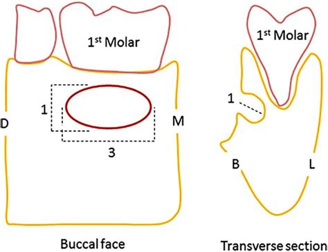 Fig Ure 1 Bone Defect Buccal Face And Transverse Section Of The Download Scientific Diagram