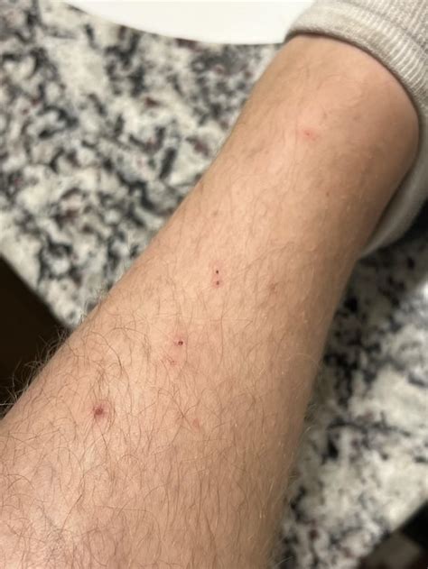 Does This Look Like A Bed Bug Or Scabies Bite Rbugbites