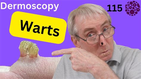 The Dermoscopy And Management Of Viral Warts In General Practice Youtube