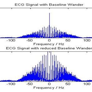 Frequency Domain Fft Representation Of Ecg Power Line Interference Download Scientific Diagram