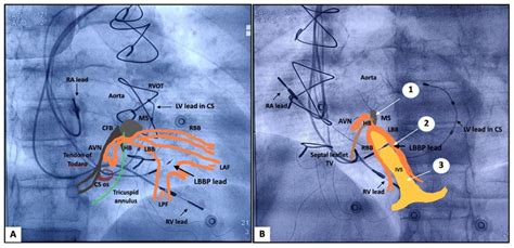 Diagrammatic Illustration Of Conduction System Anatomy For Csp In A Download Scientific Diagram