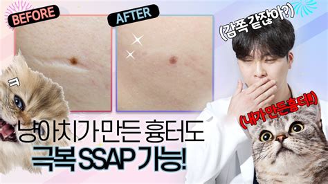 어린 시절 고양에게 긁힌 흉터 흉터 치료 과정 공개 고양이흉터 손톱흉터 새살침 Youtube