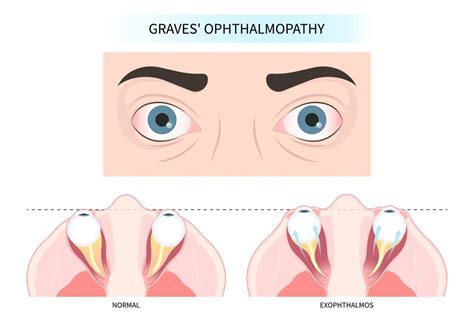 Understanding Exophthalmos Key Causes And Effective Treatments