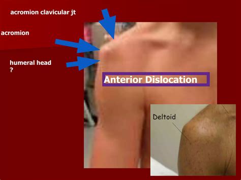 Dislocation And Subluxation 3 Ppt