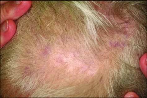 Scalp Tumors Prodinger 2018 Jddg Journal Der Deutschen Dermatologischen Gesellschaft