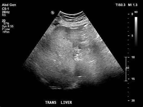 Cholangiocarcinoma Radiopaedia