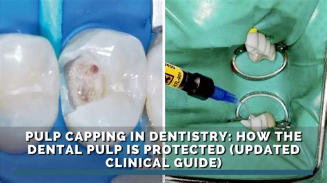 Pulp Capping In Dentistry How The Dental Pulp Is Protected Updated