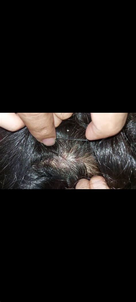 Ask A Dermatologist Online For Ringworm On Scalp