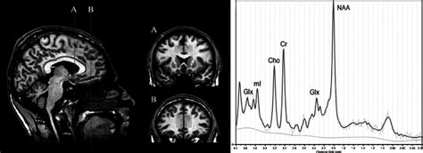 A Functional Subdi V Isions Of The Anterior Cingulate Cortex ACC On Download Scientific