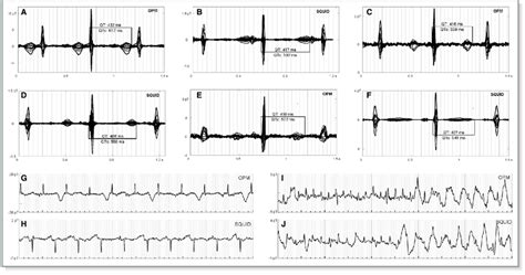 long qt syndrome waveforms and rhythms fetuses 18 a and b 19 c
