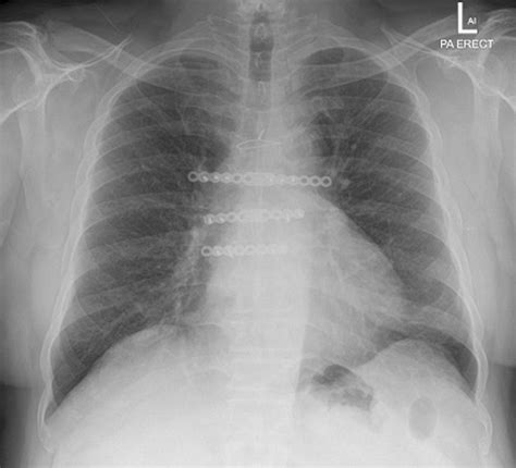 A Radiologists Guide To Median Sternotomy Clinical Radiology
