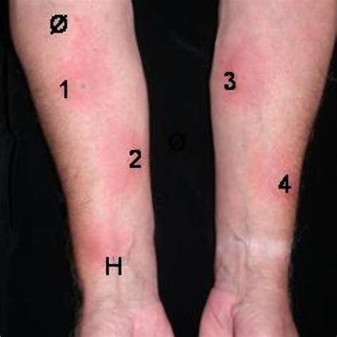 Pdf Successful Desensitization With Human Insulin In A Patient With