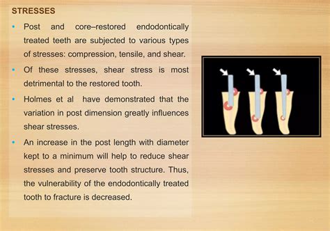 Restoration Of Endodontically Treated Teeth Ppt
