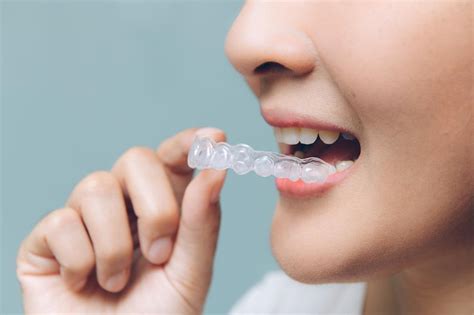 How Does Invisalign Work Wayne Hickory DMD MDS MS Orthodontics