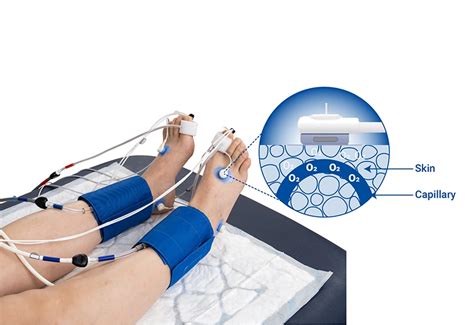 Validating The Effectiveness Of Hyperbaric Oxygen Therapy With Tcpo2 Perimed