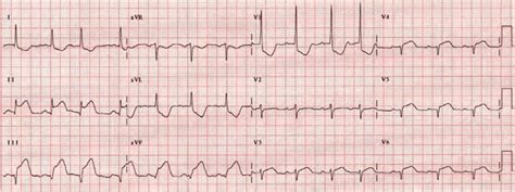 Posterior Stemi Infarction Ecg Book