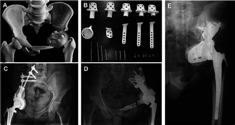 A A 3d Diagram Illustrates Reconstruction With Modular Hemipelvic Download Scientific Diagram