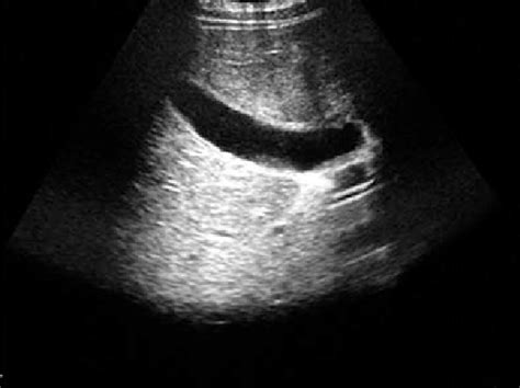 Over Distended Gallbladder Download Scientific Diagram