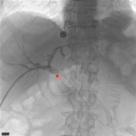 Percutaneous Biliary Stent Removal For Benign Biliary Stricture Post Hepaticojejunostomy Bmj