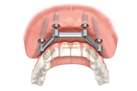 Tandimplantaten Centrum Mondzorg Riemst