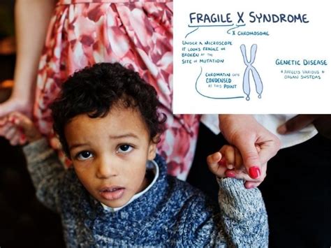 Fragile X Syndrome Fxs What It Is Symptoms And Treatment