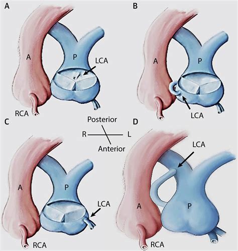 Echocardiographic Diagnosis Of Anomalous Origin Of The Left Coronary